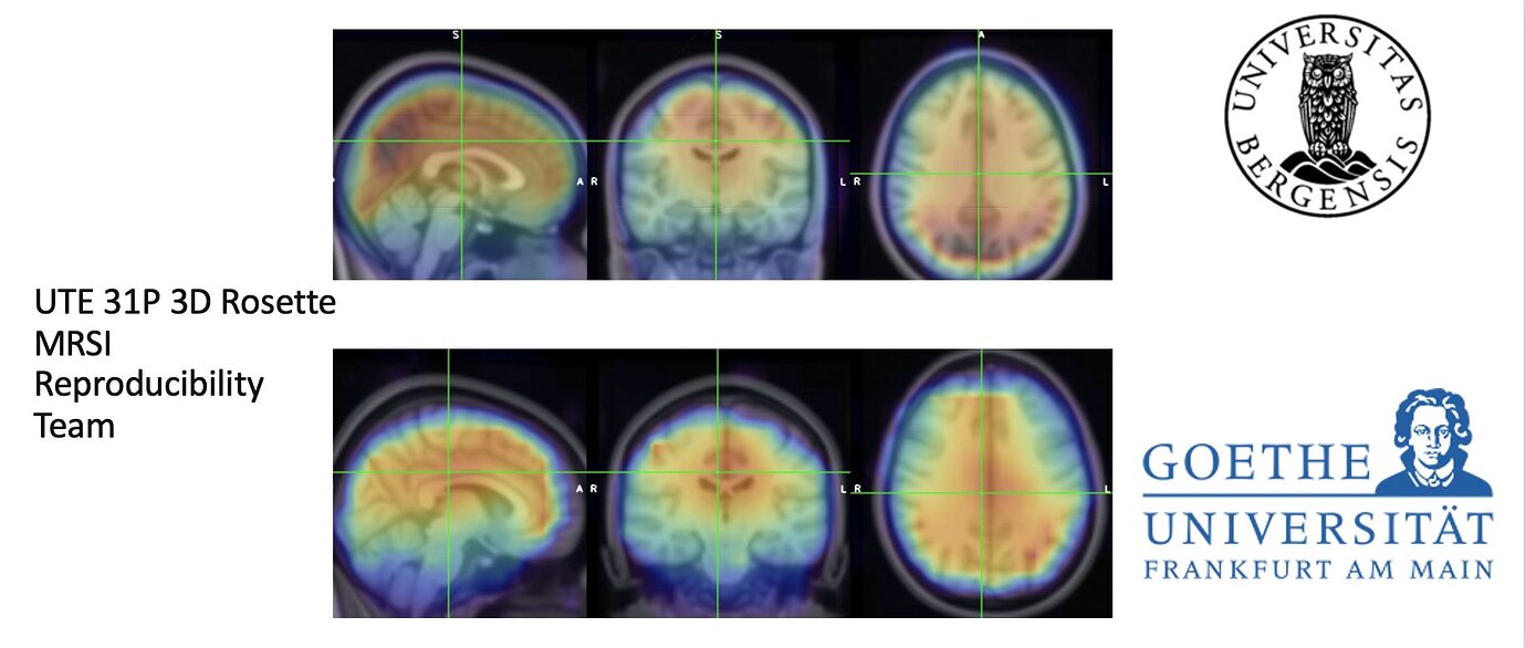 Repeat It With Me: Reproducibility Team Challenge : UTE 31P 3D MRSI at ...