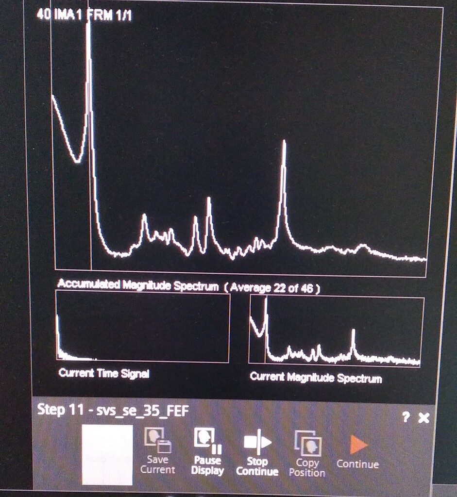 Slope next tp water signal - Siemens - MRSHub Forum